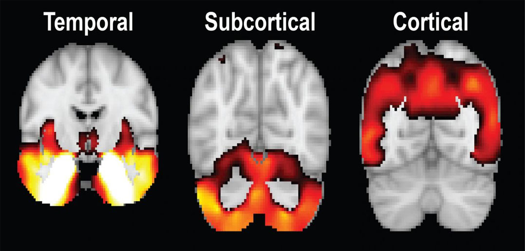 Different brain atrophy patterns may explain variability in Alzheimers ... Different brain atrophy patterns may explain variability in Alzheimers ...