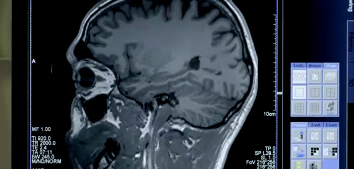 Brain degeneration in Huntington's disease caused by amino acid deficiency