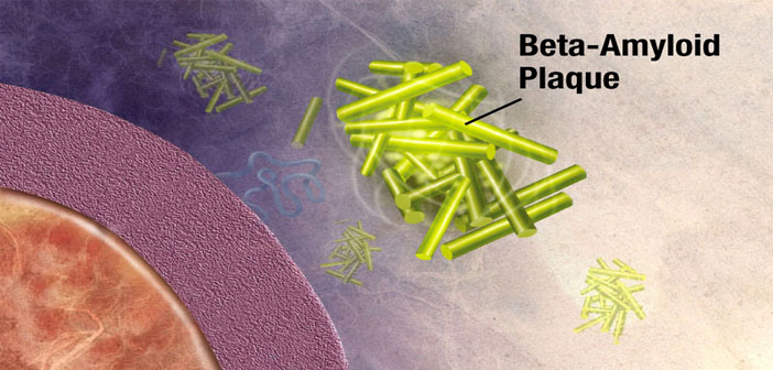 Alzheimer's amyloid clumps found in young adult brains