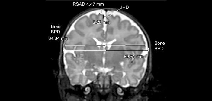MRI shows brain abnormalities in late preterm infants