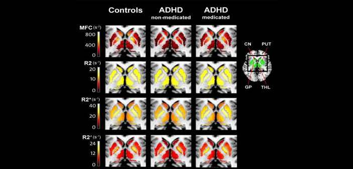 MRI technique may help prevent ADHD misdiagnosis