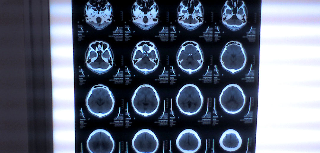 Depression damages parts of the brain, research concludes