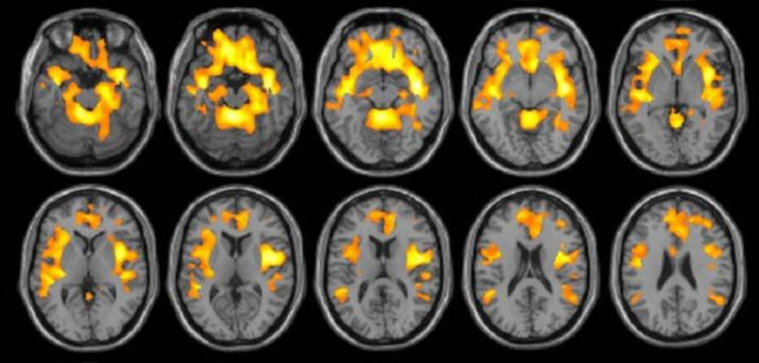Substance Abuse Reduces Brain Volume In Women But Not Men Substance Abuse Reduces Brain Volume In Women But Not Men