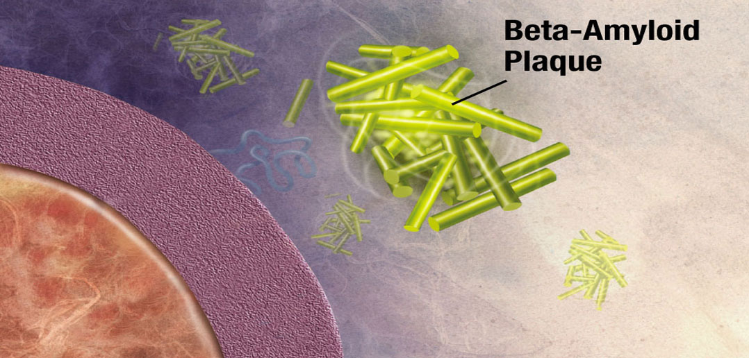 Cannabinoids remove plaque-forming Alzheimer's proteins from brain cells