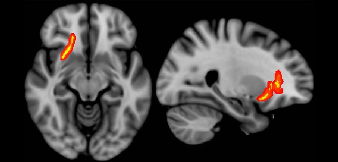 MRI shows brain disruption in children with PTSD