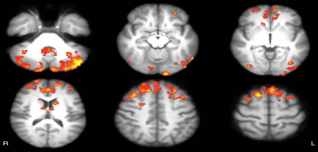 Video games improve brain connections in multiple sclerosis patients