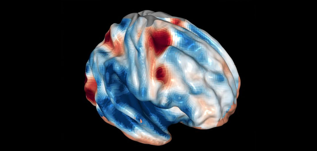 Typical male brain anatomy associated with higher probability of autism ...