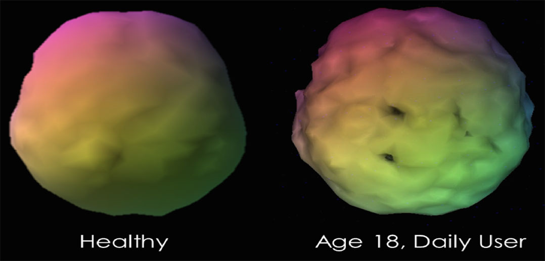 New study shows marijuana users have low blood flow to the brain