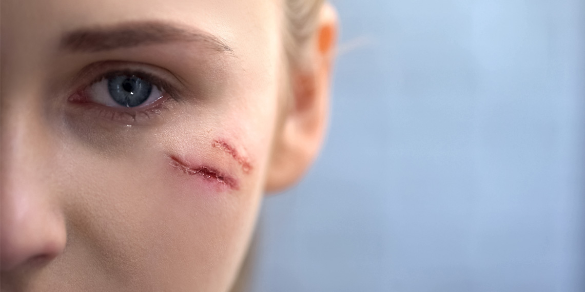 New research uncovers the effects of facial scars on first impressions ...